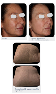 ResurFX Fractionated laser – QSD