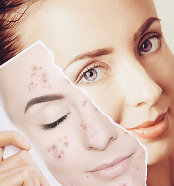 Acne treatment – QSD